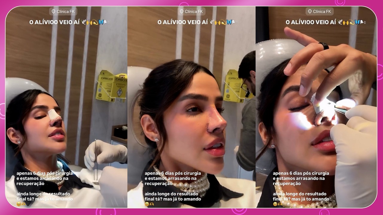 Kerline mostra resultado após rinoplastia; veja o antes e depois | Gshow