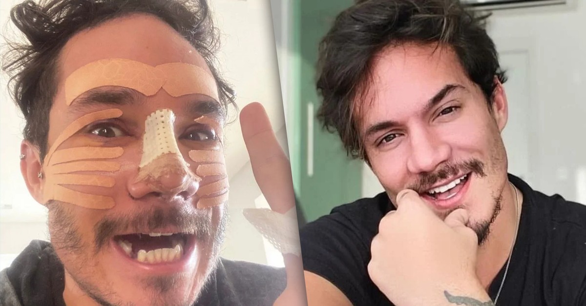 Eliezer surge irreconhecível com tala e tape cirúrgico após rinoplastia ...