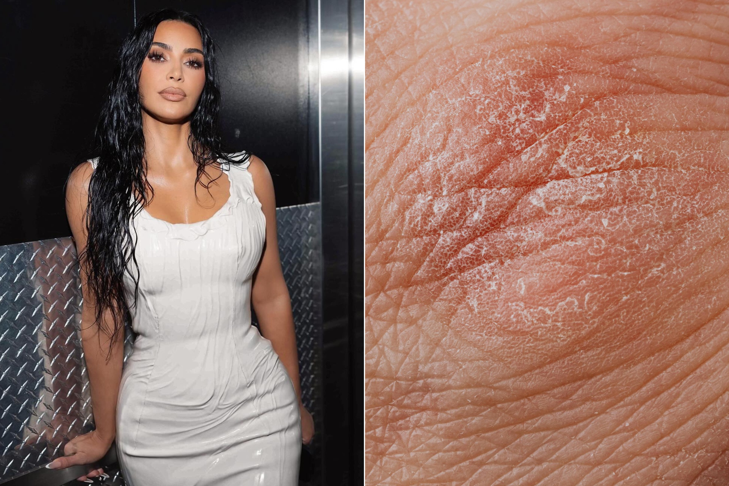 Psoríase: saiba mais sobre a doença e conheça os tratamentos | Gshow