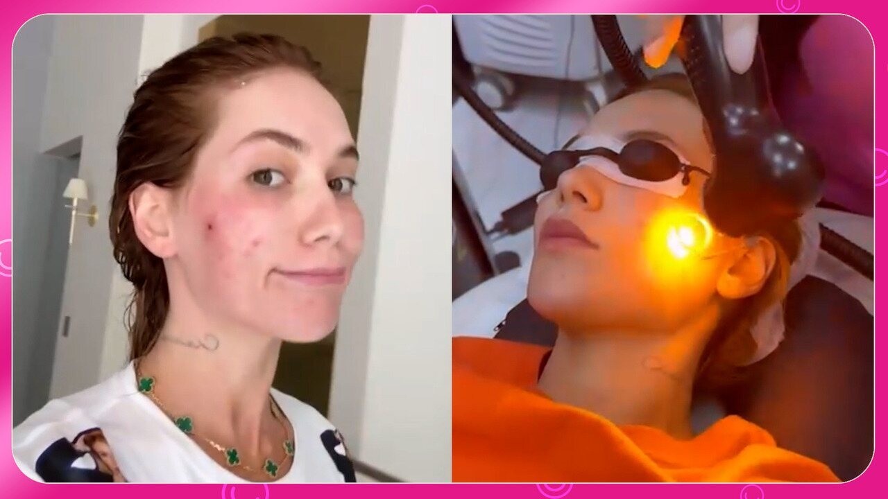 Virginia mostra rosto inchado após procedimento estético: 'Achei que ia ...